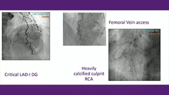 ST-segment elevation myocardial infarction (STEMI)