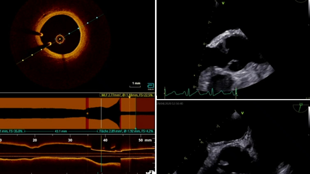 STEMI: how to treat the thrombus