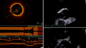 NSTEMI (Non-ST-segment elevation myocardial infarction)