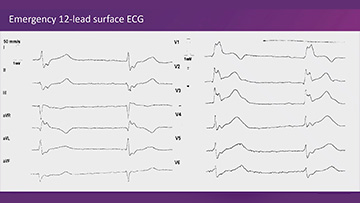 STEMI in unusual anatomy