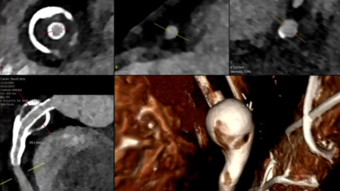 ST-segment elevation myocardial infarction (STEMI)