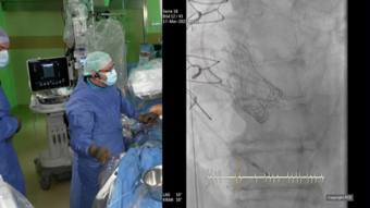 TAVI (Transcatheter aortic valve implantation)