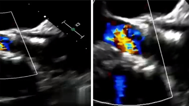 TAVI in TAVI procedures