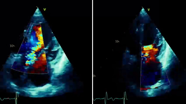 TAVI: novel devices and technologies