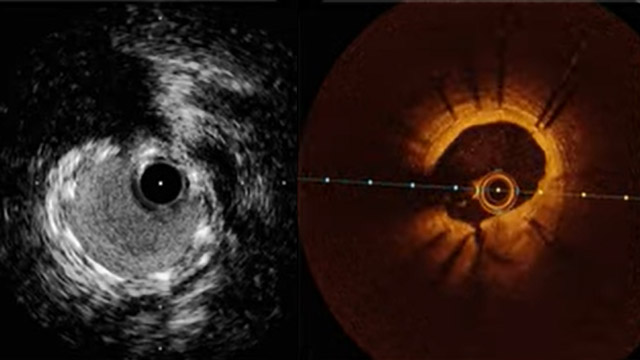 The next generation DES technology: innovative DES+DCB stent platform