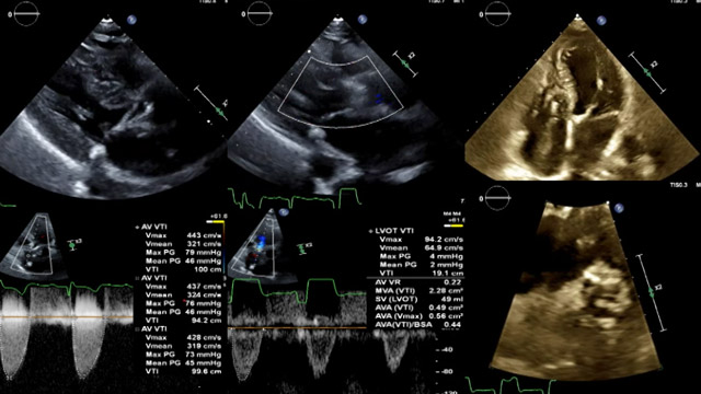 Newer generation self-expanding platform: technical optimisation for ...