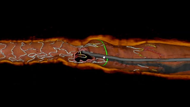 Next-generation complex PCI toolkit and novel balloon expandable Myval THV
