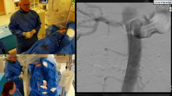 Renal denervation (RDN)