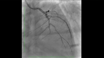 TAVI (Transcatheter aortic valve implantation)