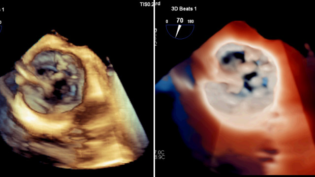 aortic stenosis echocardiogram