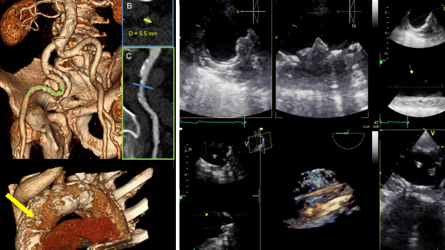Imaging before and after TAVI - How to treat
