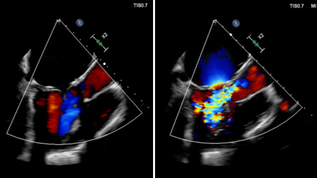 The challenge of aortic regurgitation: better imaging for better ...