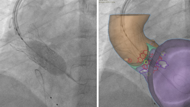 Advanced imaging for structural interventions