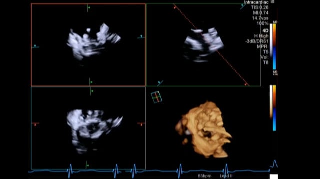 Expert roundtable: 4D ICE in tricuspid interventions