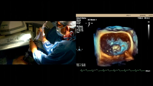 How to treat my patient with primary mitral regurgitation?