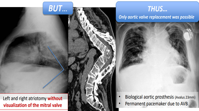Mitral TEER - Part 1