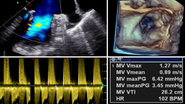 Mitral TEER - Part 2
