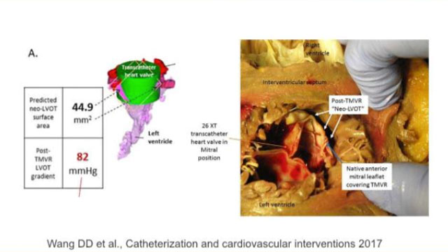 Mitral valve intervention in complex scenarios - Valve-in-valve, valve ...
