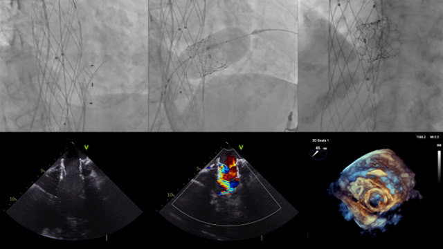 New devices for tricuspid valve intervention