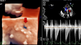 Other valvular and structural interventions