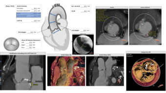 TAVI (Transcatheter aortic valve implantation)