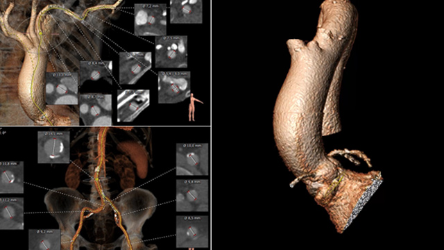 TAVI - Alternative access - Part 2