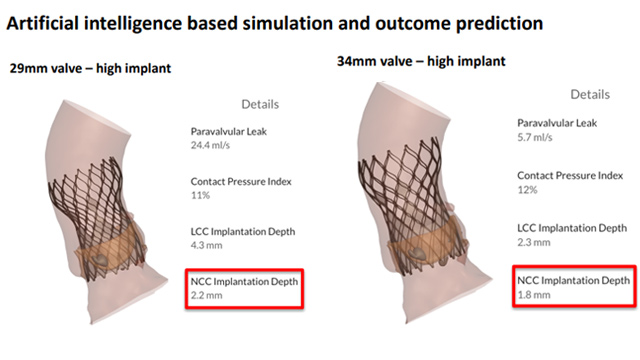 TAVI - computer simulation and pre-procedural modelling