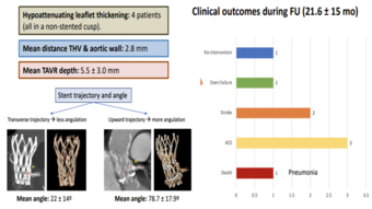 TAVI (Transcatheter aortic valve implantation)