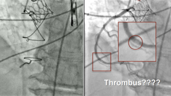 TAVI (Transcatheter aortic valve implantation)