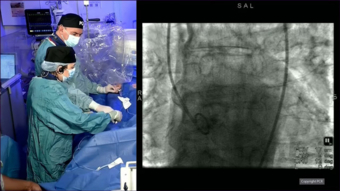 TAVI (Transcatheter aortic valve implantation)