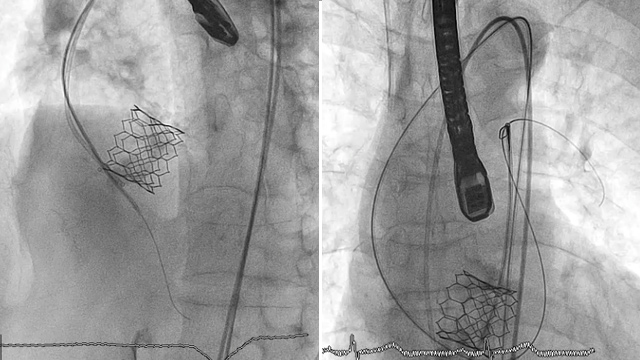 TAVI in bicuspid anatomy - Part 1