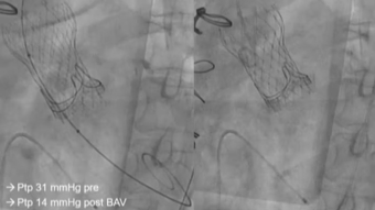 TAVI (Transcatheter aortic valve implantation)