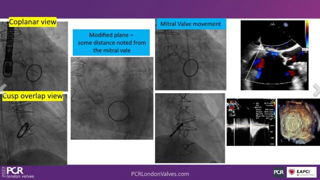 TAVI in complex scenarios