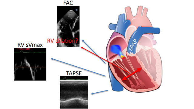 Tricuspid TEER - Part 2