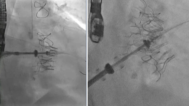 Tricuspid transcatheter valve replacement: Cardiovalve keeps things in ...