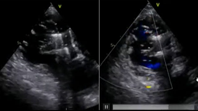 Tricuspid valve intervention in complex scenarios - Tackling tricuspid ...