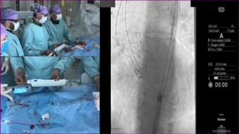 TAVI (Transcatheter aortic valve implantation)