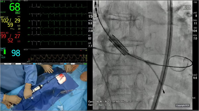 TAVI in a patient with heavily calcified valve anatomy - LIVE case