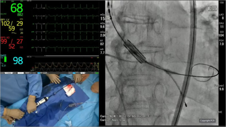 TAVI (Transcatheter aortic valve implantation)