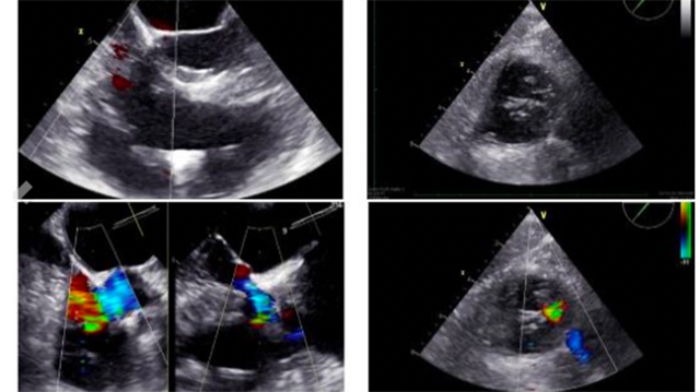 Tricuspid valve interventions - Case studies