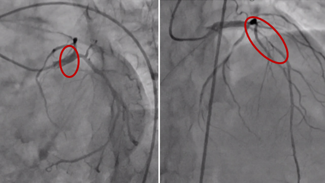 Bifurcation and stable CAD - Navigating complex cases with creativity ...