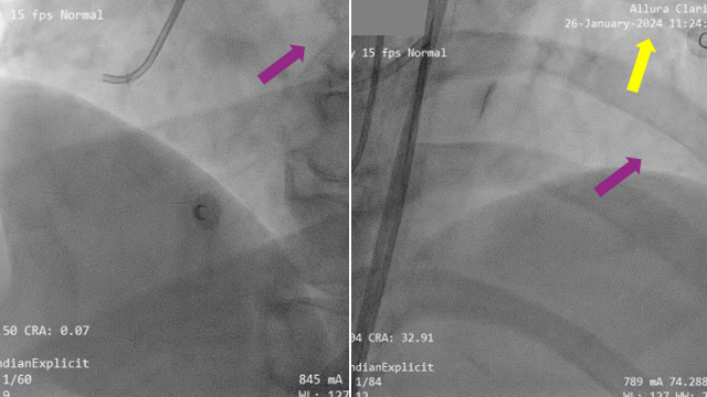 Bifurcation and stable CAD: Tackling challenges in complex clinical ...