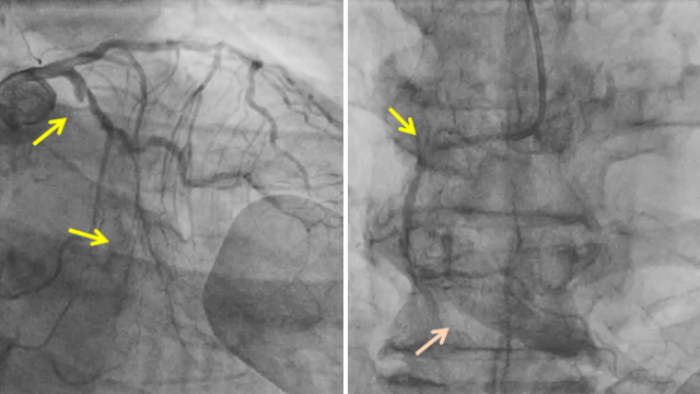 CTO PCI: Addressing acute no-flow, multivessel challenges and calcified ...