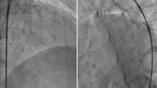 Mastering complex CTO interventions: Techniques, challenges, and ...