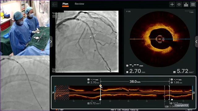 Hybrid procedure: Stent and DCB for a long diffuse lesion - LIVE case