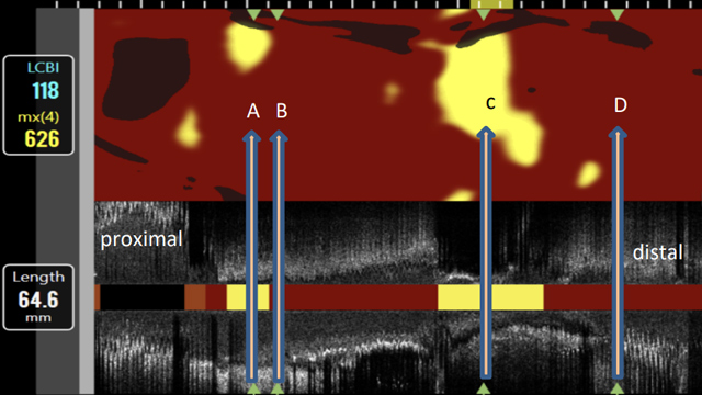 DCB and intracoronary imaging: Navigating complex coronary interventions