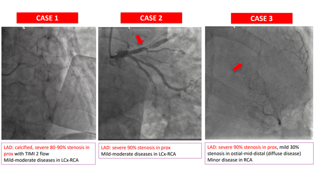 Managing severe calcified LAD lesions in STEMI: Insights from three cases