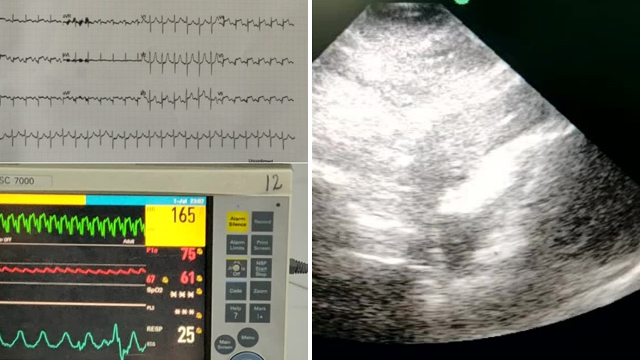 Challenging STEMI cases