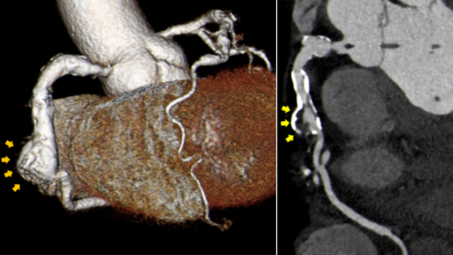 Complex STEMI cases: Dextrocardia, thrombosis and coronary aneurysms
