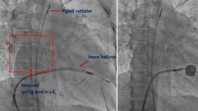 TAVI and Mitral: Advanced techniques for complex valve interventions
